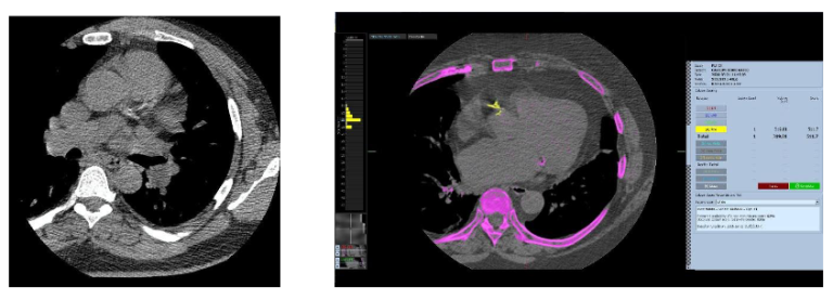 What is a Calcium Score and Why is it Important for Your Heart Health ...